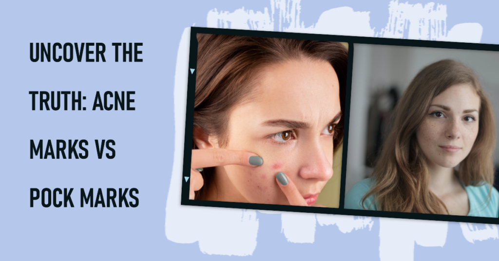 Differences Between Acne and Pock Marks: uncovering the Truth